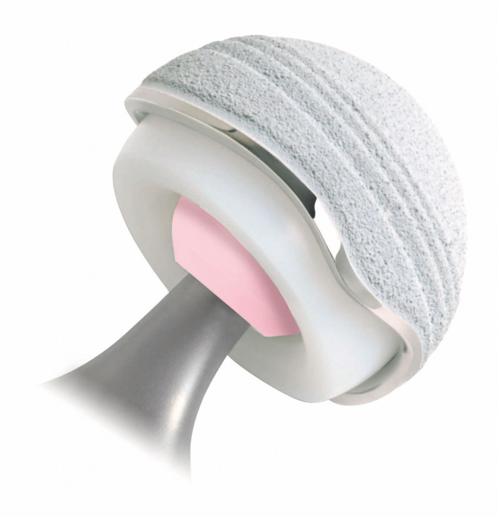 DePuy Hip Settlement – Modified DePuy Hip Settlement